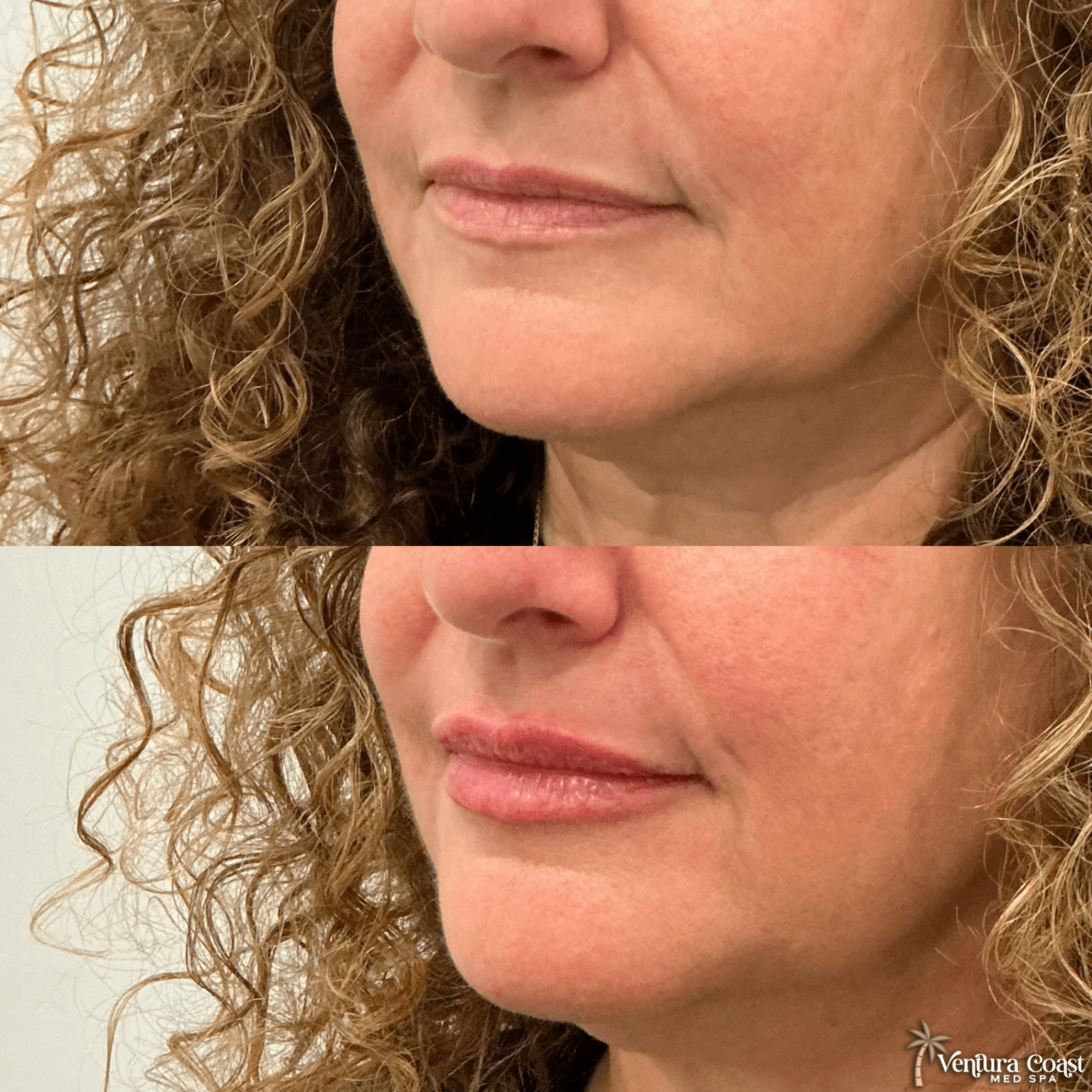 Dermal Fillers - Ventura Coast Med Spa